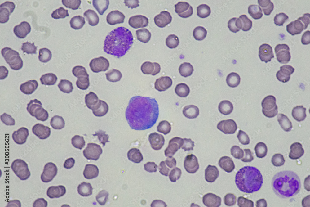 Acute Leukemia Cells