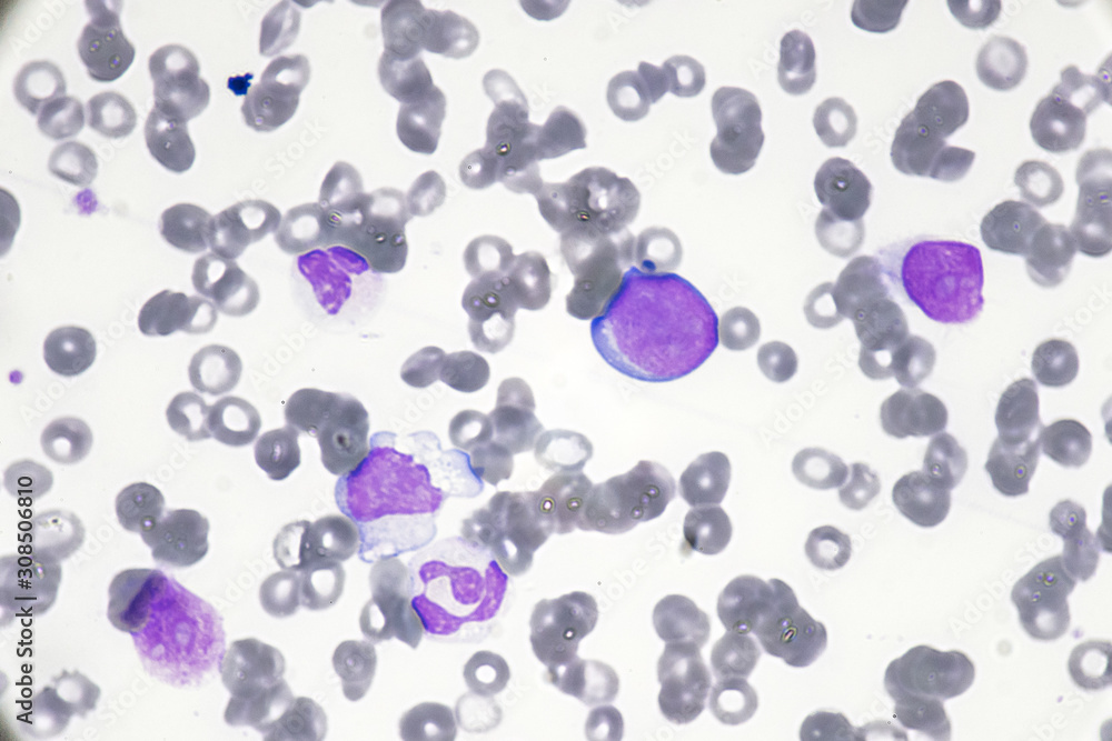 Blast cell (Acute myeloid leukemia in Human) Stock Photo | Adobe Stock