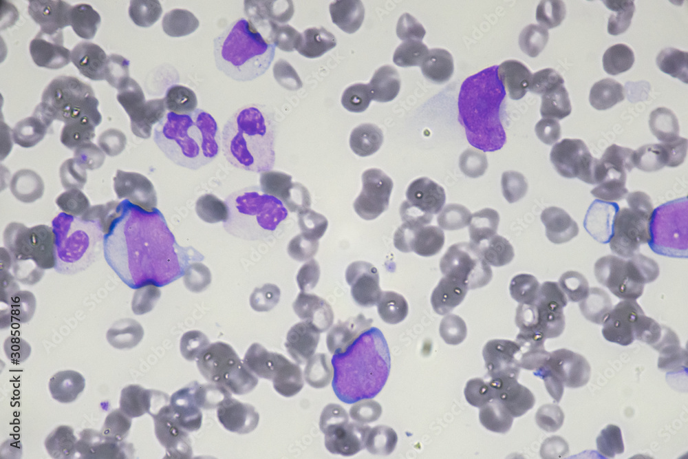 Acute myeloid leukemia (Blast cell , Whote blood cells) Stock Photo ...