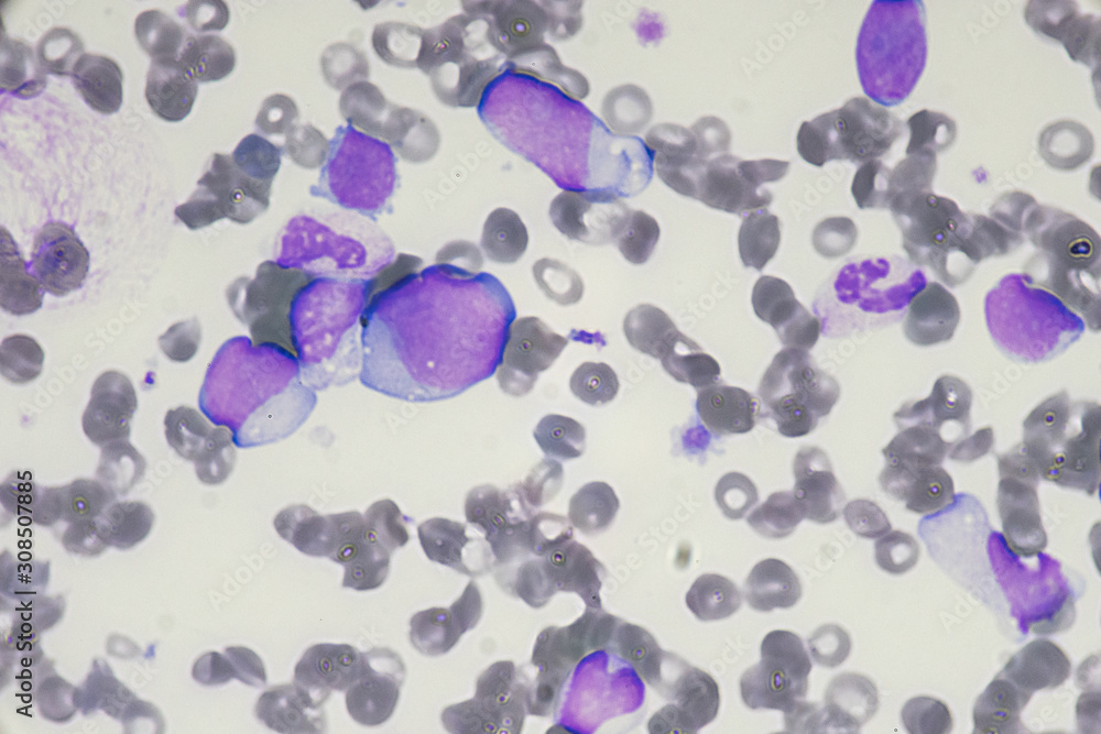 Acute myeloid leukemia (Blast cell , Whote blood cells) Stock Photo ...
