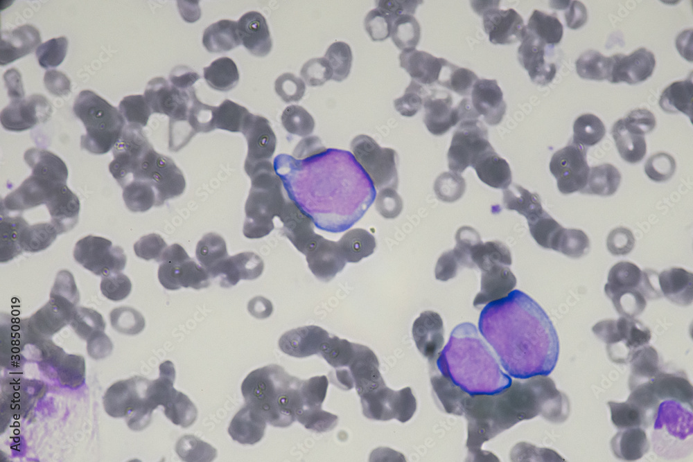 Acute myeloid leukemia (Blast cell , Whote blood cells) Stock Photo ...