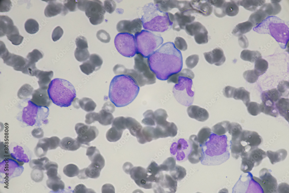 Acute myeloid leukemia (Blast cell , Whote blood cells) Stock Photo ...