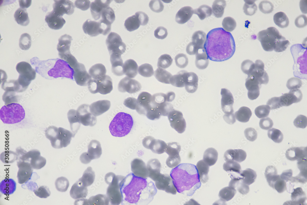 Blast cell in Acute myeloid leukemia from human blood cells (White ...