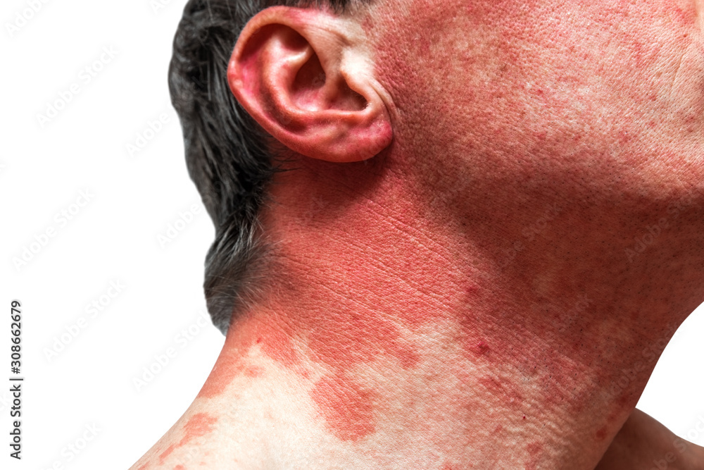 Human Skin Allergies