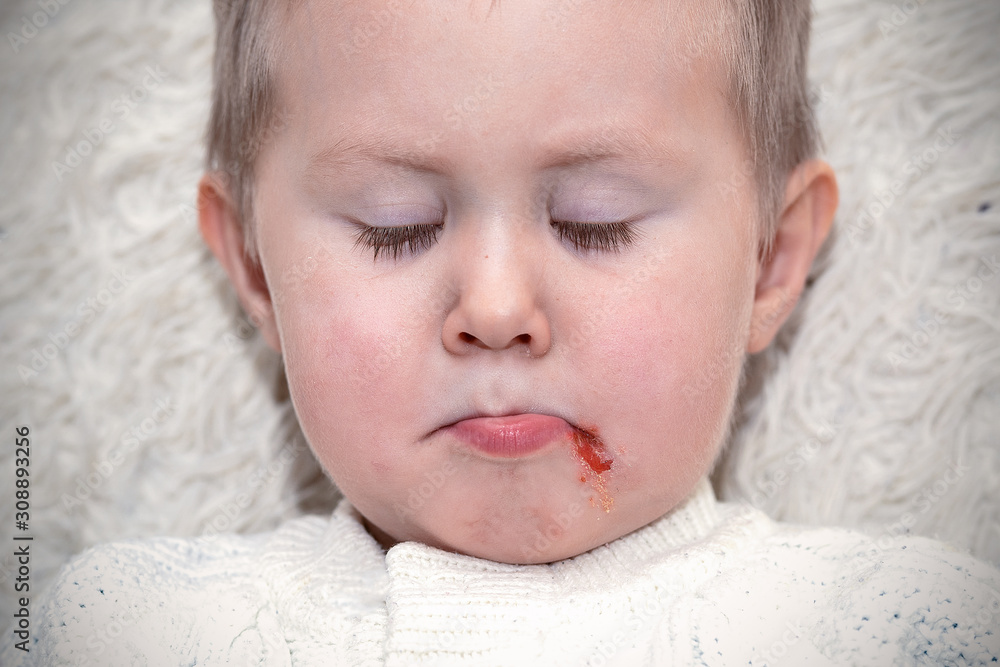 Herpes on upper lip of a little girl. Wound on the face of a schoolboy ...