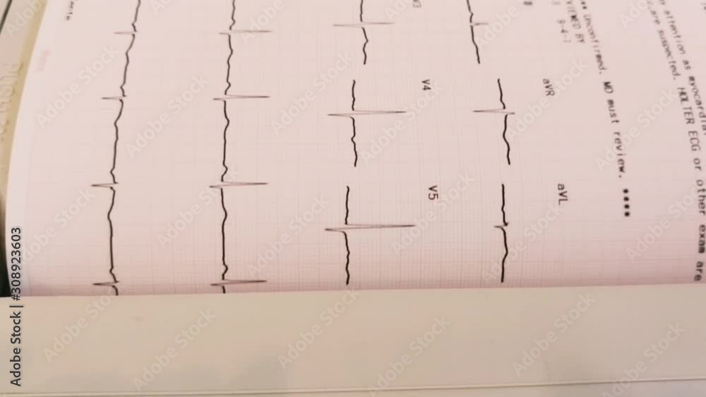 Tracing paper of EKG result. Perform electrocardiogram test on tracing ...