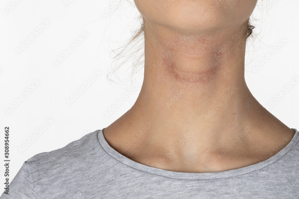 Allergic itchy skin on girl neck. Teen with rash dry skin on neck ...