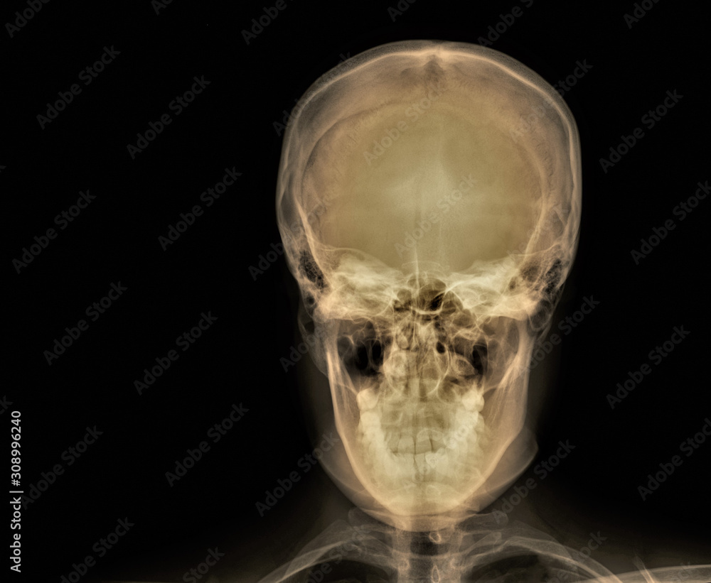 normal x-ray of the skull in direct projection, medical diagnostics ...
