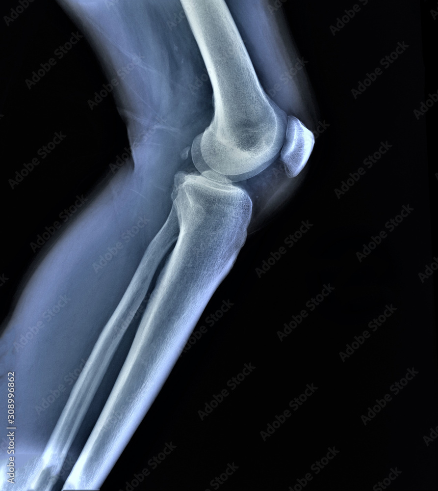 x ray of the knee joint , medical diagnostics, traumatology and ...