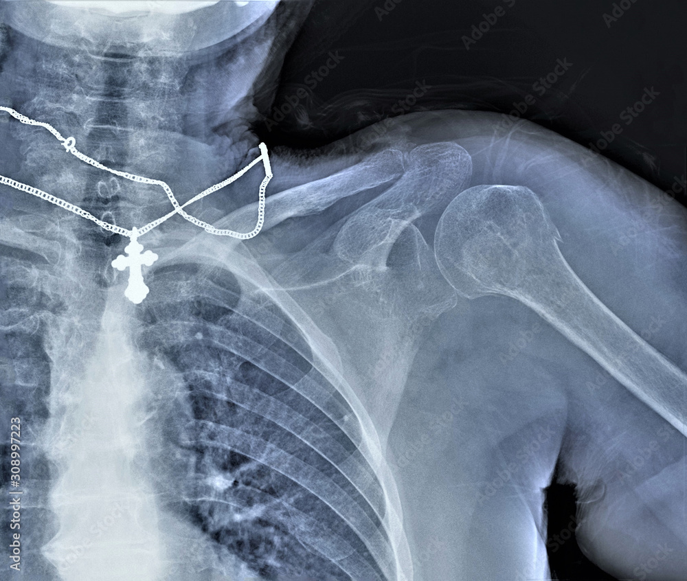 x-ray of the shoulder joint of an adult male, medical diagnosis ...