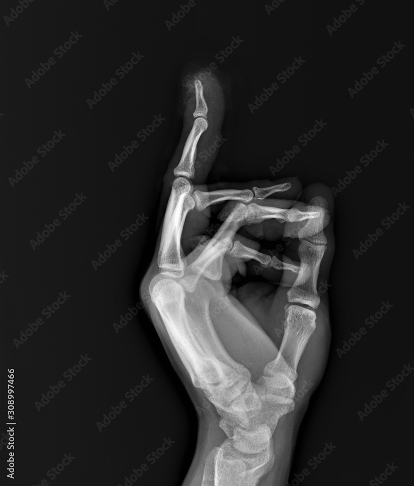 x-ray of hand bones, diagnosis of diseases Stock Photo | Adobe Stock