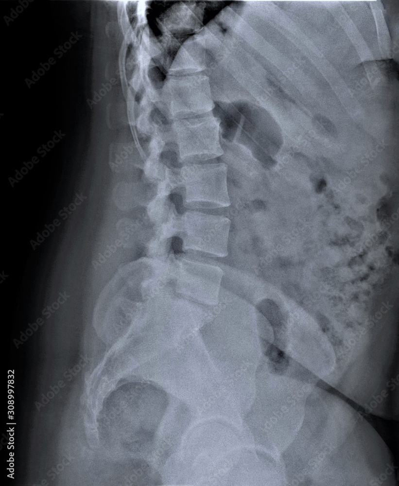 x ray of lumbar and sacral spine in lateral projection, medical ...