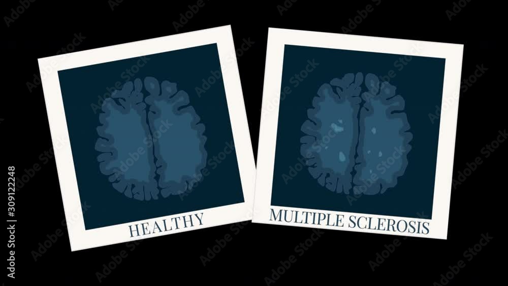 Multiple sclerosis motion graphics with MRI scan photo of healthy brain ...