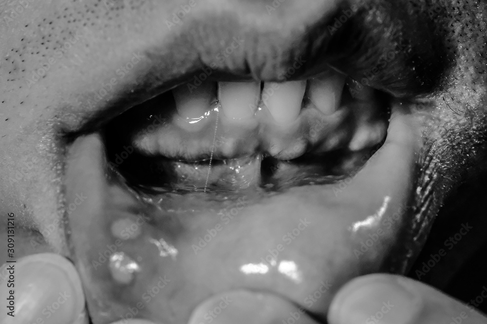 Mouth ulcers - Close up of Asian man with aphtha on lip, with copy ...