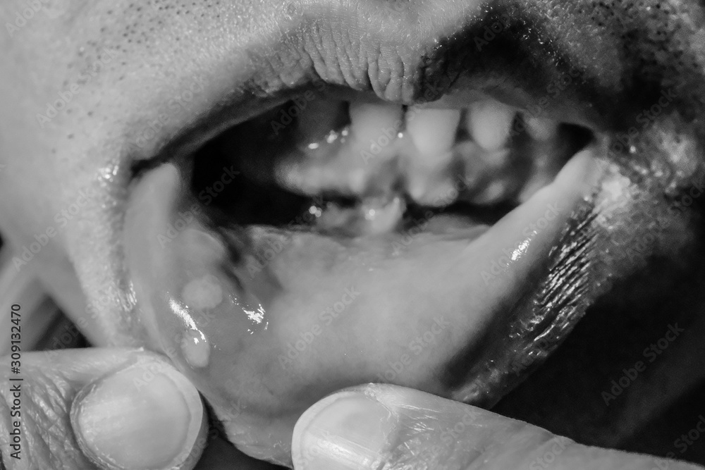 Mouth ulcers - Close up of Asian man with aphtha on lip, with copy ...