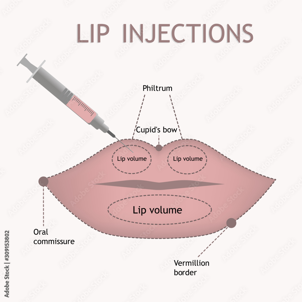 Lip injections scheme in flat style .Vector image of lip augmentation ...