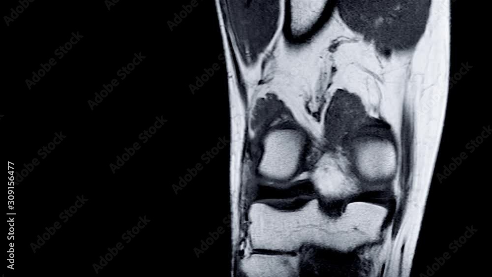 Magnetic resonance imaging (MRI) of right knee. Closed injury of the ...