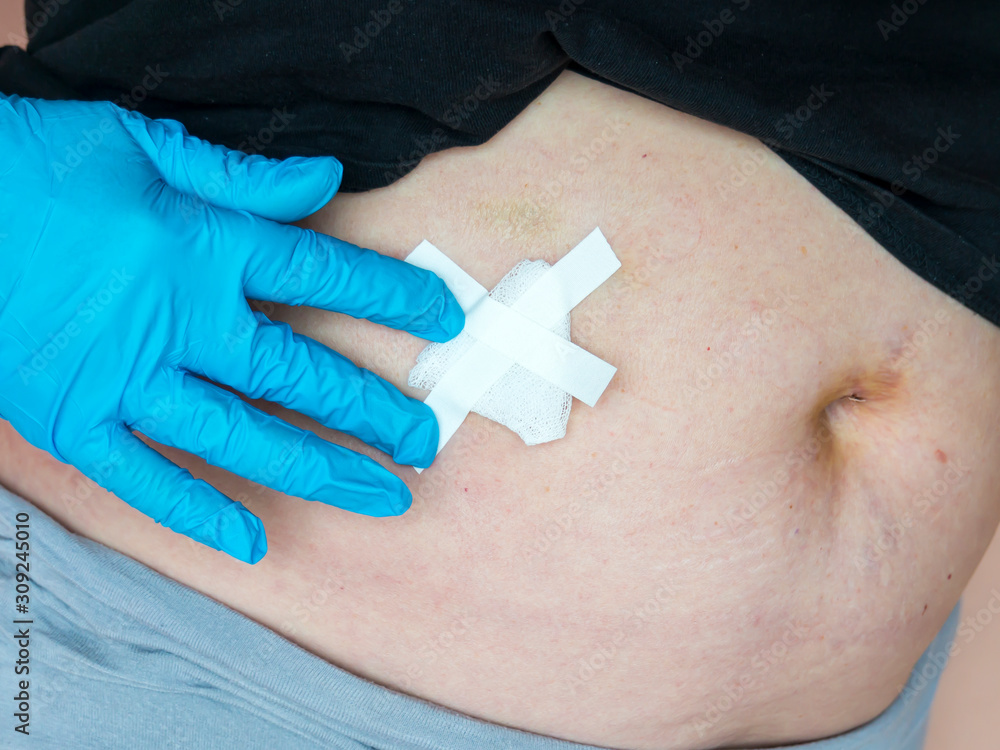 Condition after laparoscopic cholecystectomy for gallstone disease ...