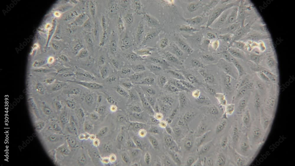 Human malignant tumor cells seen under an optical microscope Stock ビデオ ...