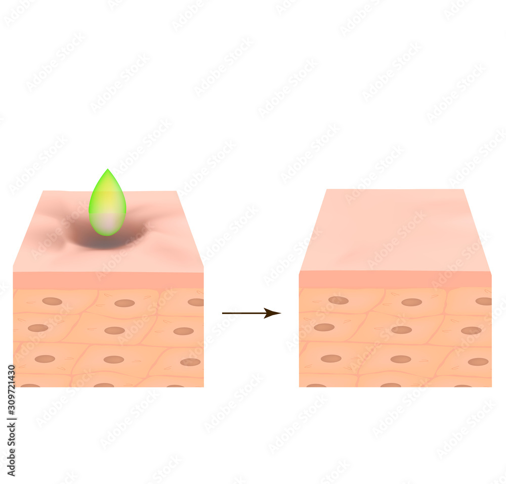 Acne scars. Acid peeling scar atrophic treatment. The anatomical ...