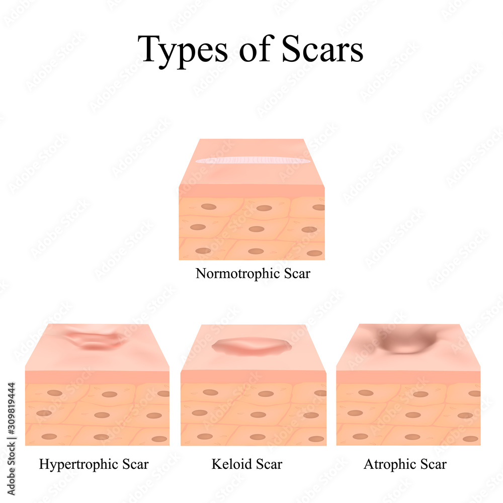 Types of scars. Acne scars. Keloid, hypertrophic, atrophic ...
