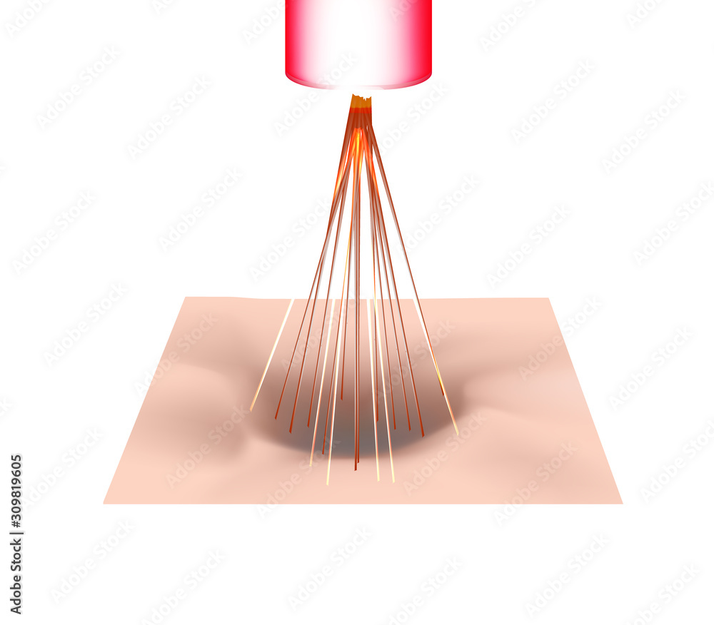 Acne scars. Laser scar atrophic treatment. The anatomical structure of ...