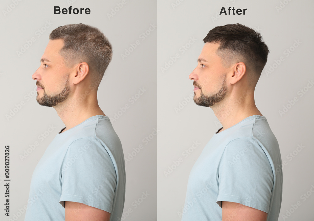 Man before and after hair loss treatment on grey background Stock Photo ...