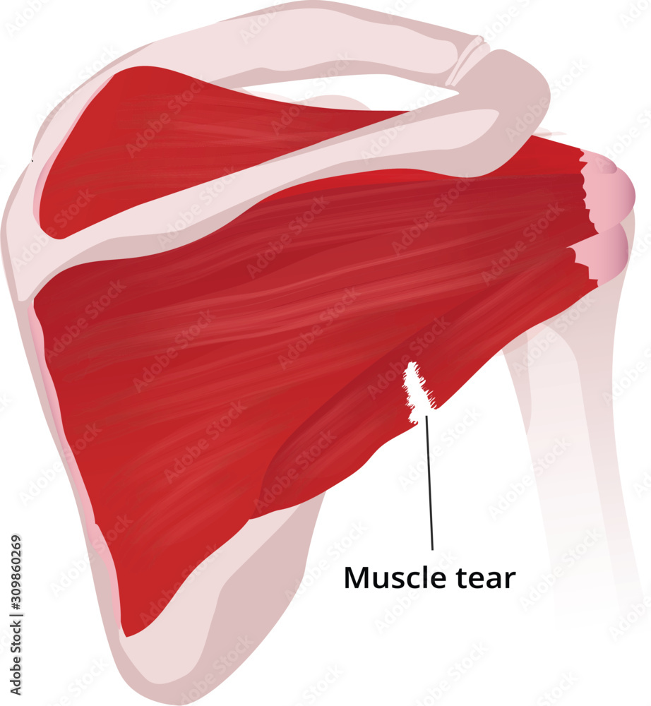 Rotator cuff tear vector. Illustration of the rotator cuff muscle ...