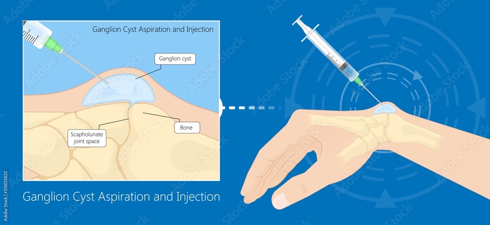 Ganglion cyst disease hand wrist trauma Stock Vector | Adobe Stock
