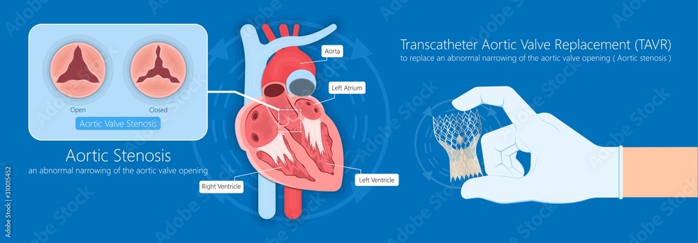 Transcatheter aortic valve replacement (TAVR) minimally invasive surgery Stock Vector | Adobe Stock