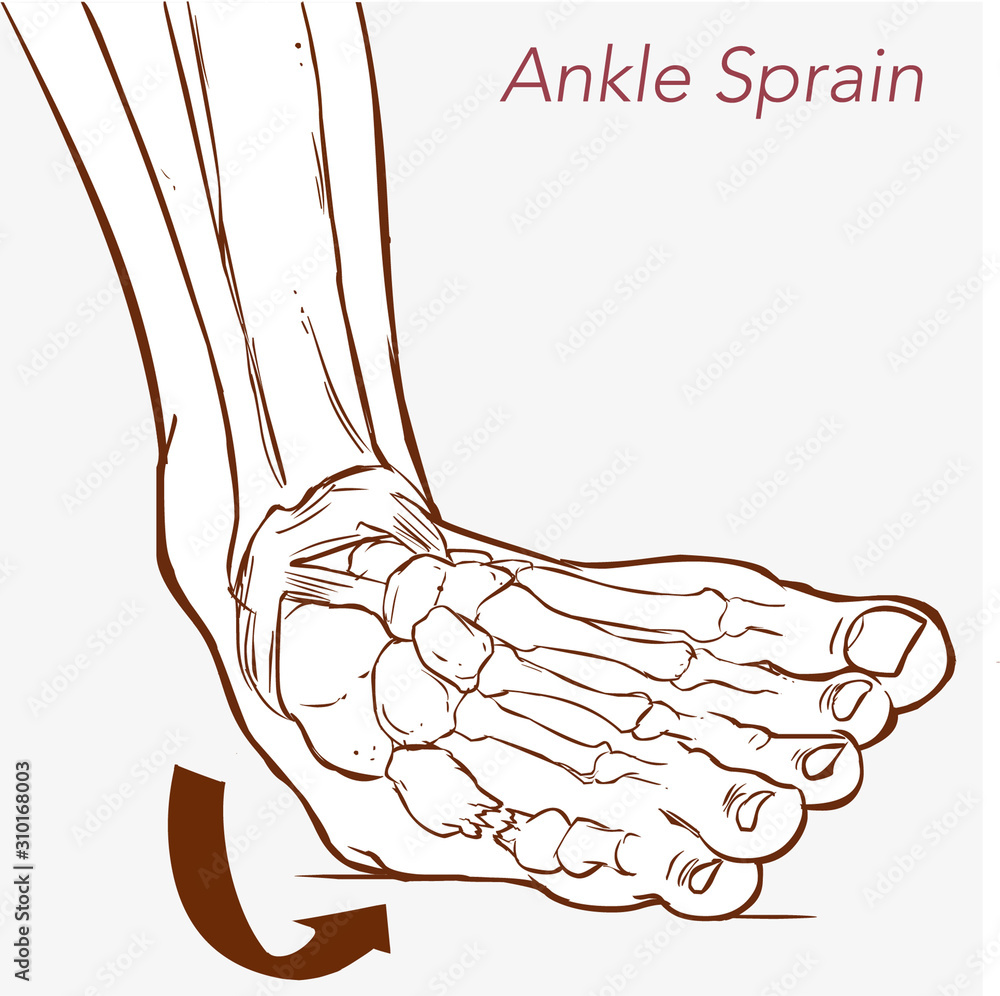 Types of ankle sprains Stock Vector | Adobe Stock