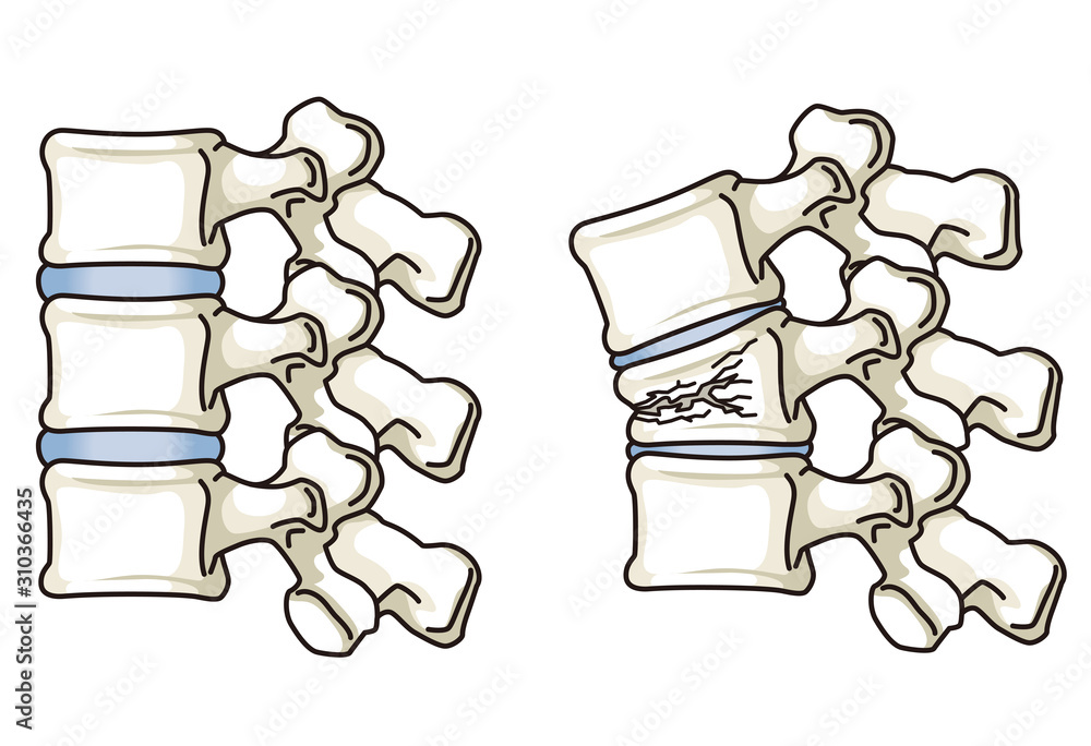 圧迫骨折 説明図 Stock イラスト | Adobe Stock