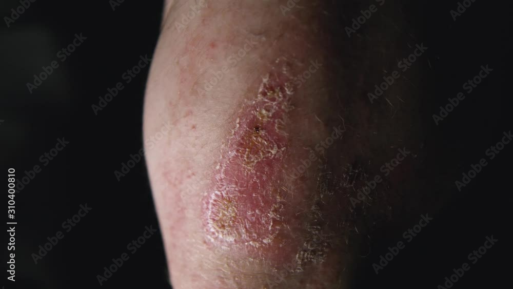 Dry scab on elbow. Partially healed. Scrape and bruise. Healing. 4k ...