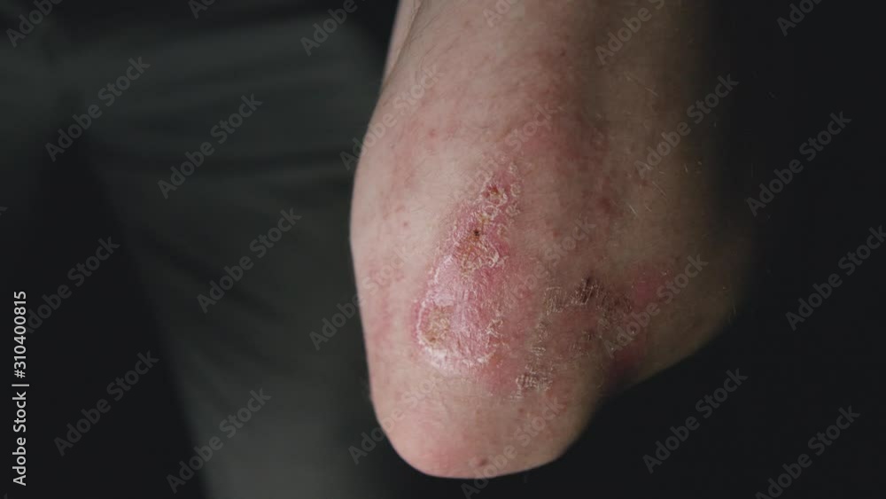 Healing scab on male elbow. One week recovery from open graze wound. 4k ...