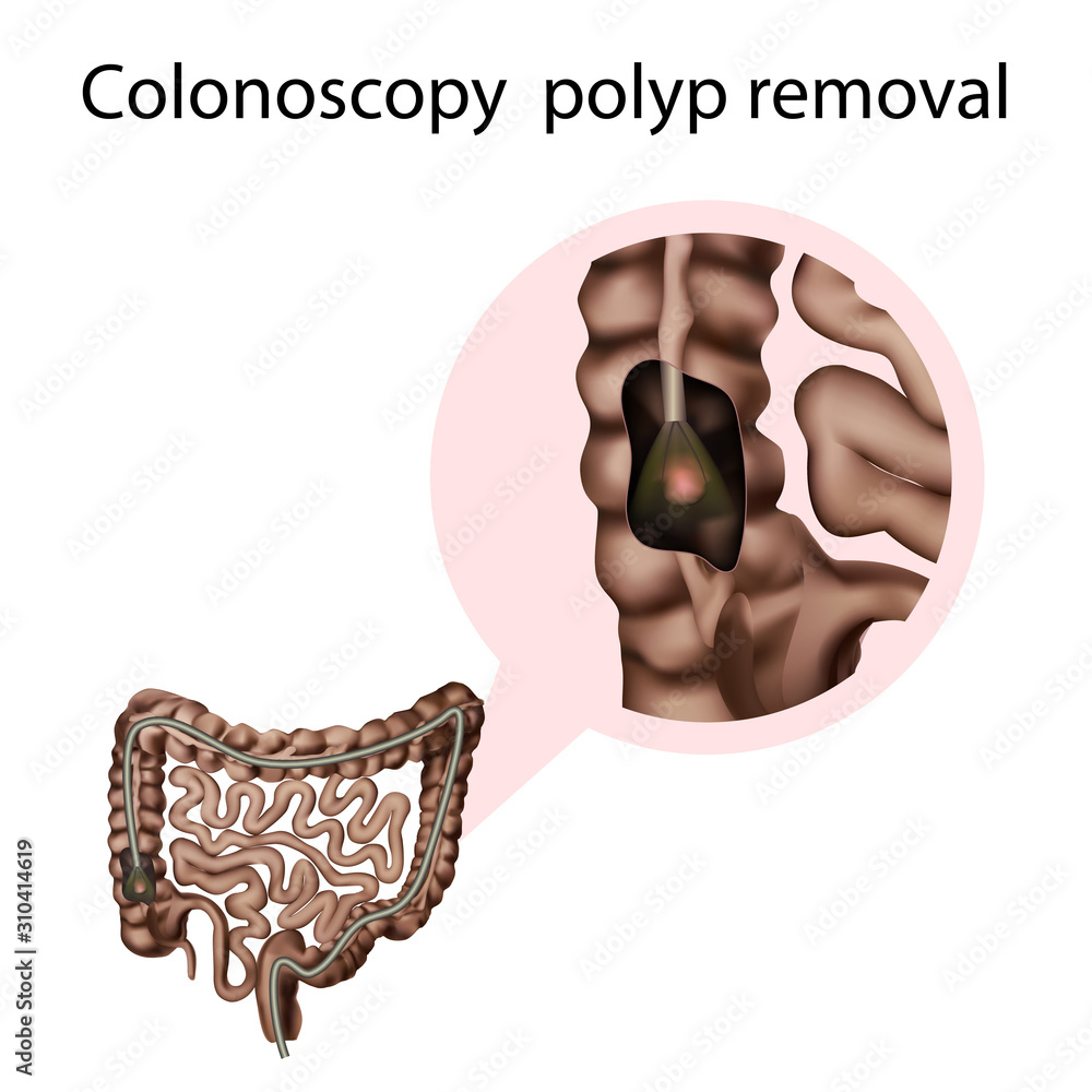 Colonoscopy polyp removal. Colonoscope, examination, endoscopy. Medical ...