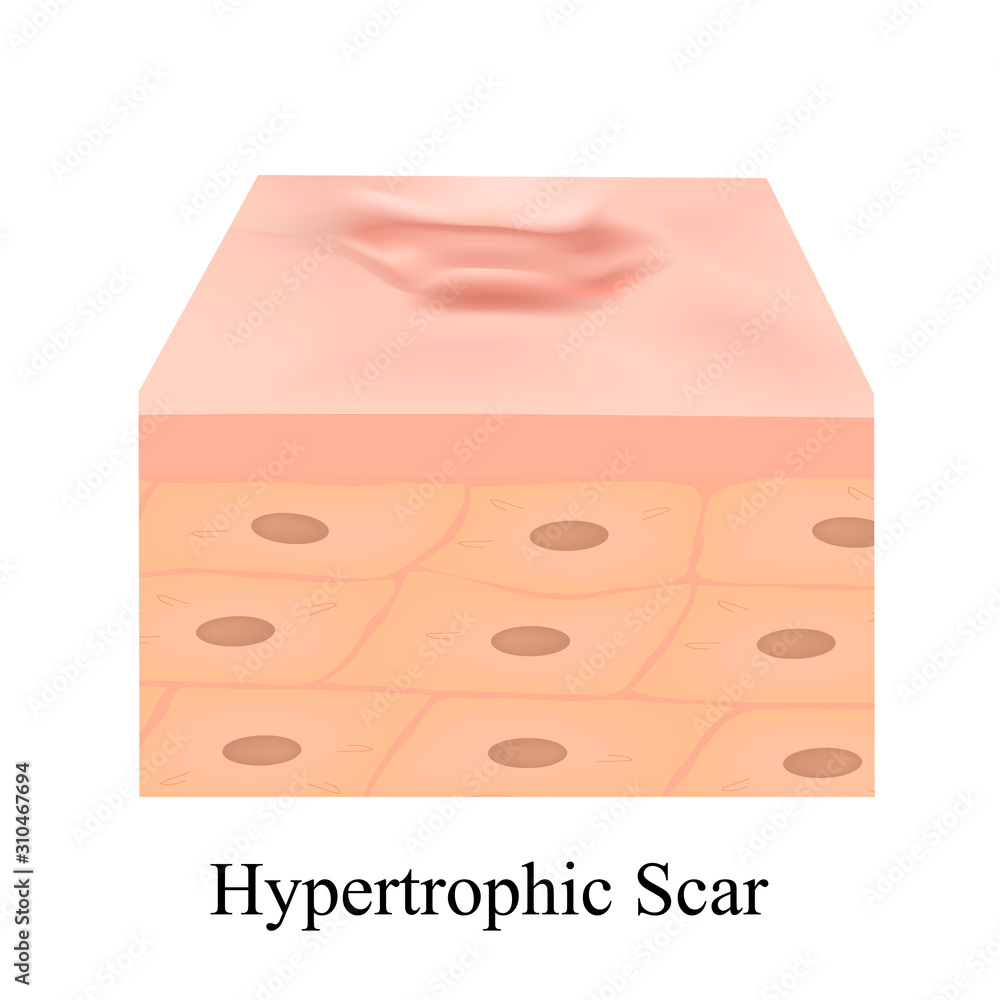 Scars hypertrophic. The anatomical structure of the skin scar. Vector ...