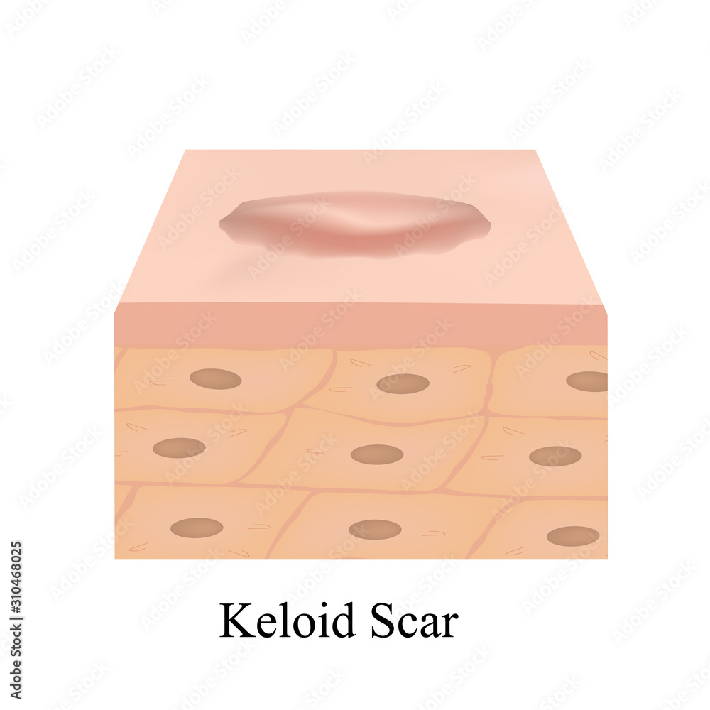 Scars Keloid. The anatomical structure of the skin scar. Vector ...
