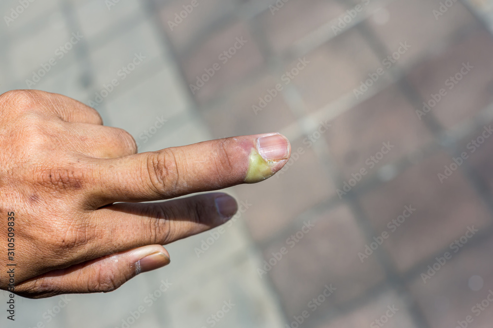 Paronychia, swollen finger with fingernail bed inflammation due to ...