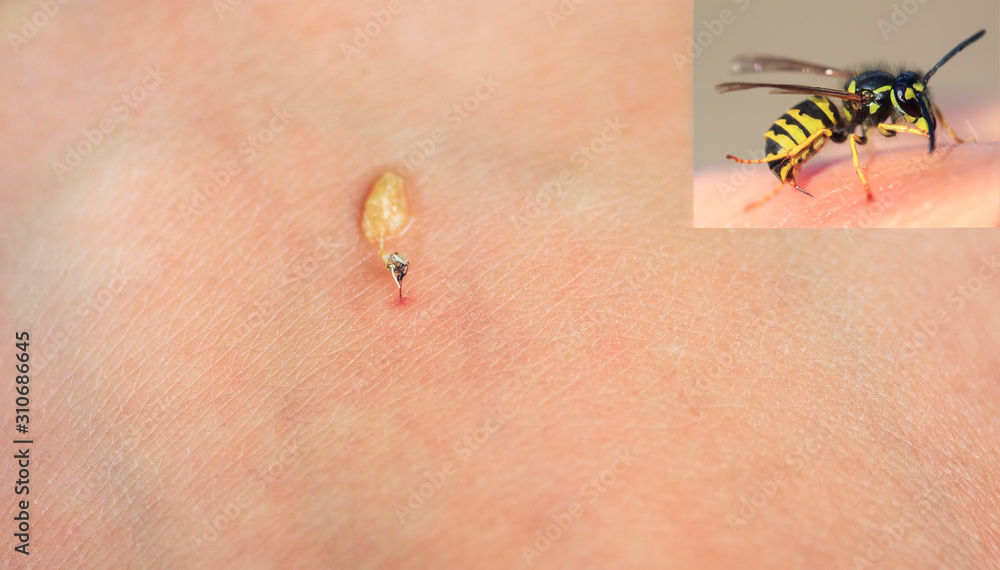 Wasp Stinger In Skin