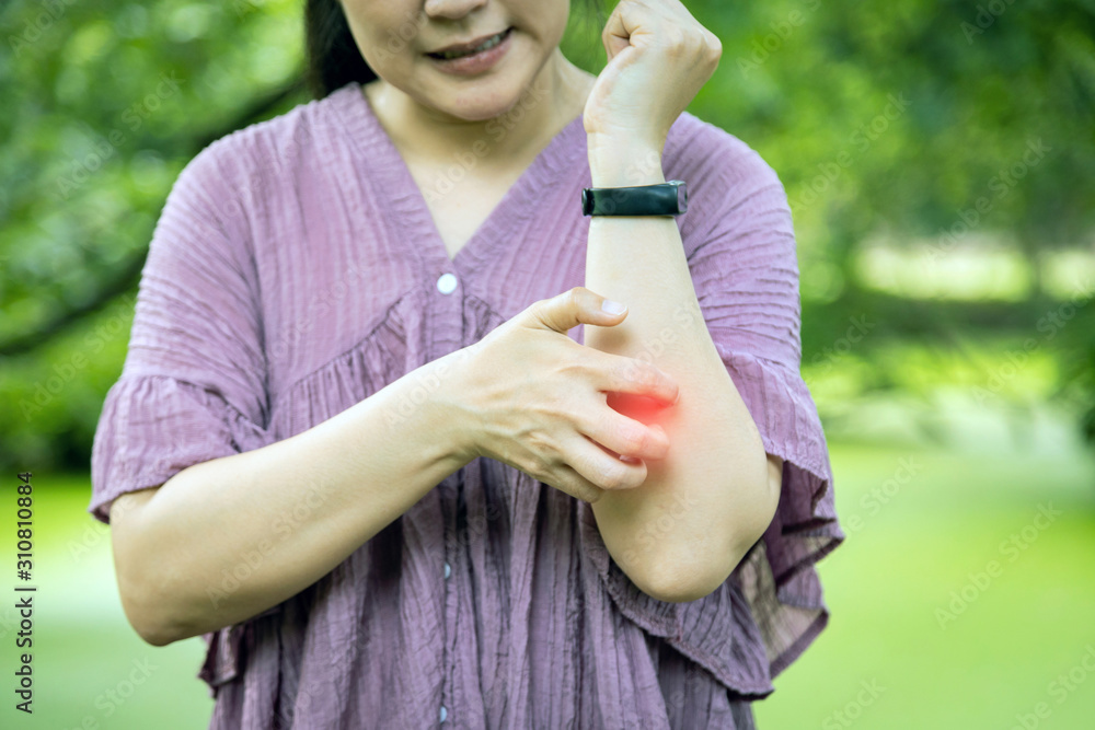 Ringworm From Mosquito Bite