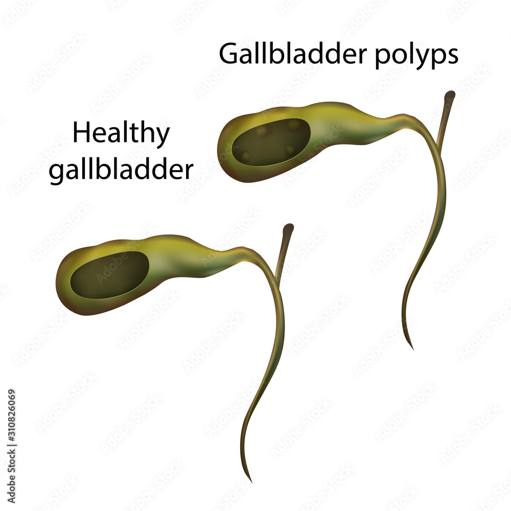 Gallbladder polyps and healthy organ. Abnormal growth of tissue ...