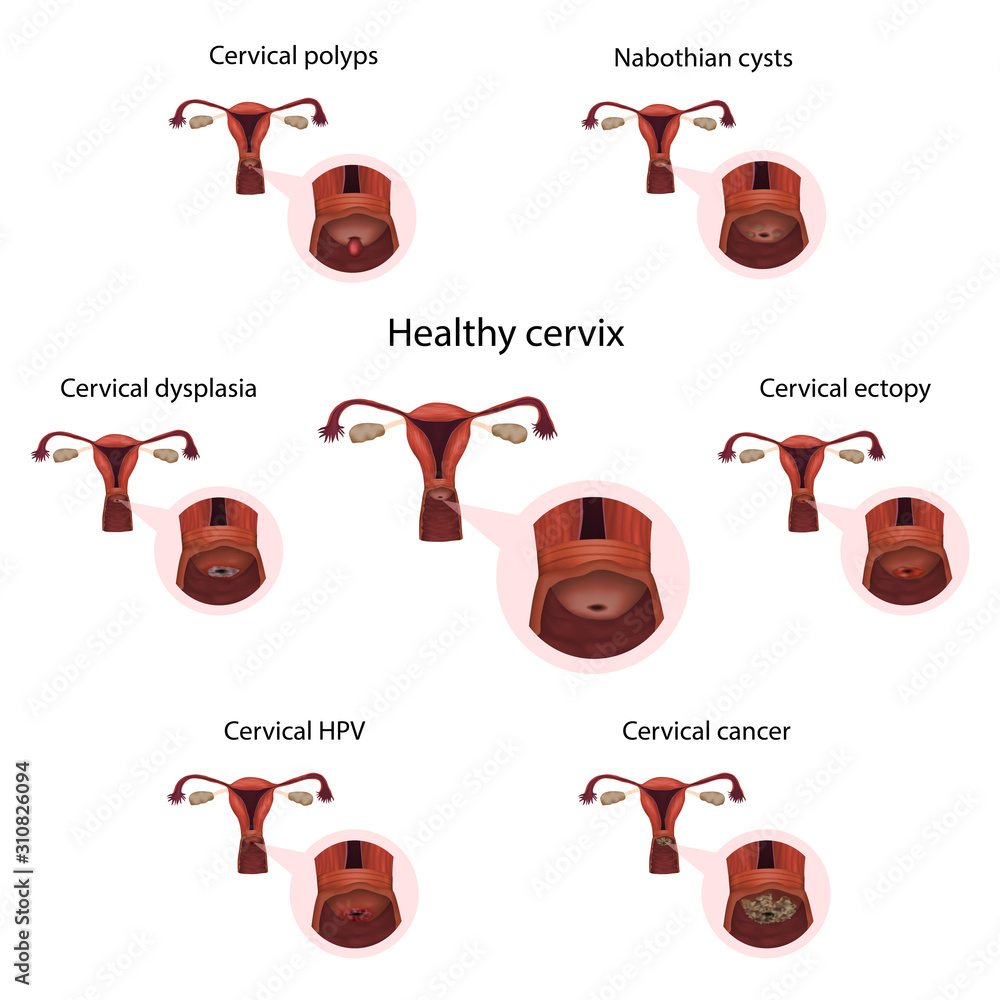 Cervical Diseases Cervix Polyps Ectopy Dysplasia Cancer Nabothian