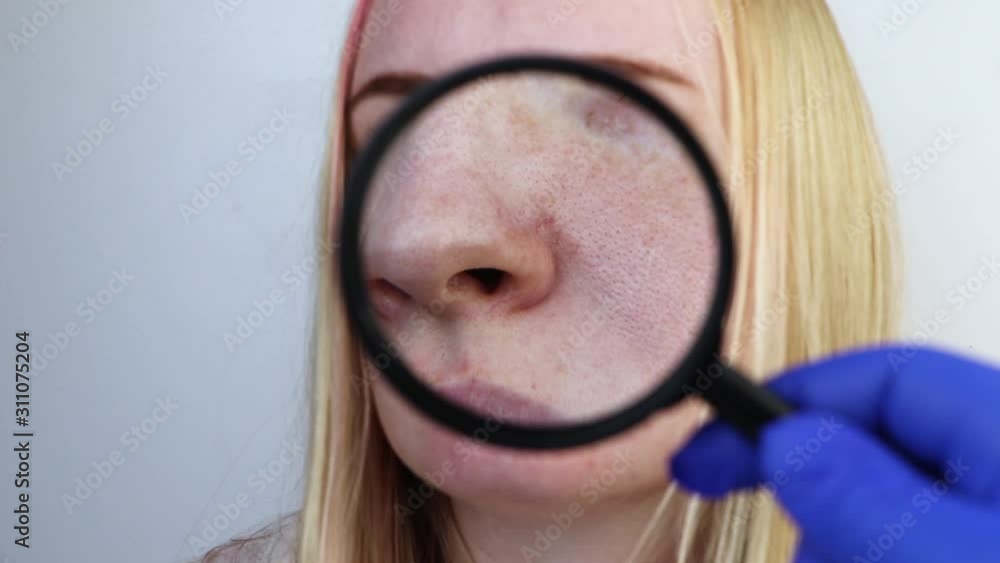 Expanded rosacea, pores, black spots, acne close-up on the nose. A ...