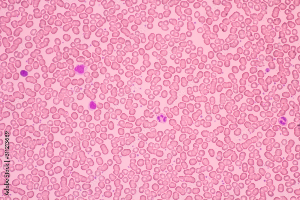 Human blood smear view in microscopy.Complete blood count for treatment ...