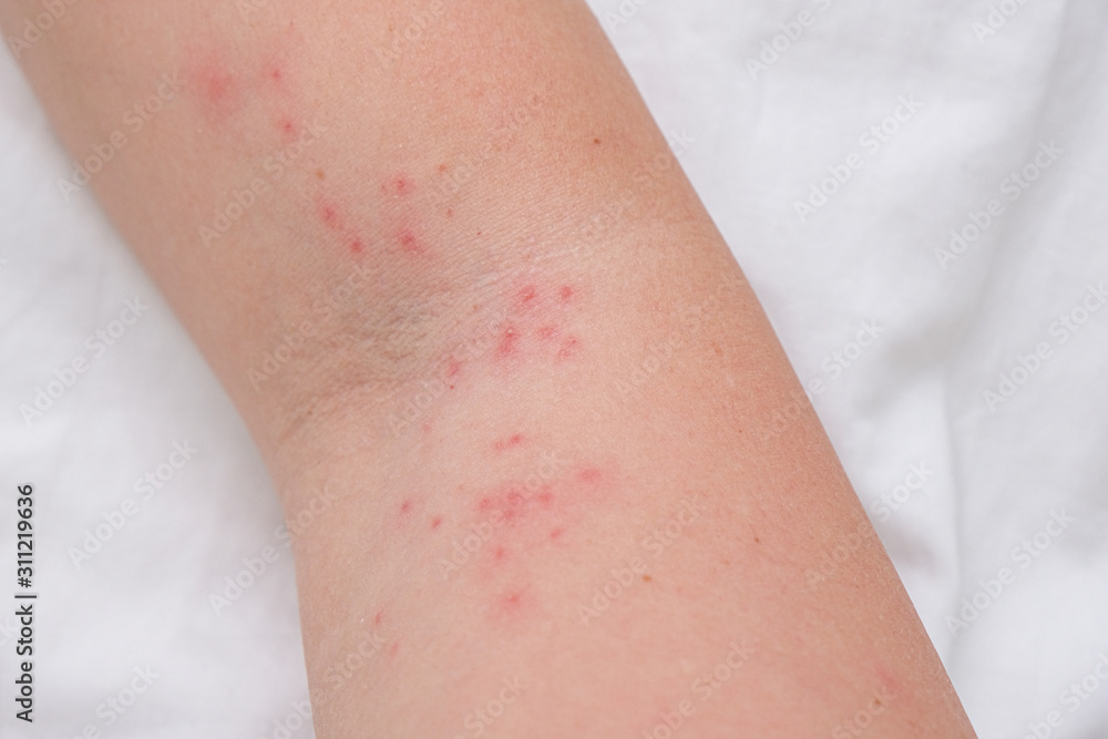 Skin rash on female arm, itchy pimples as a result of an allergic ...