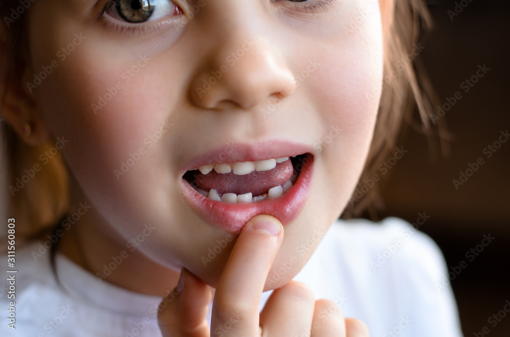 Beautiful smiling preschool girl with her first adult incisor tooth ...