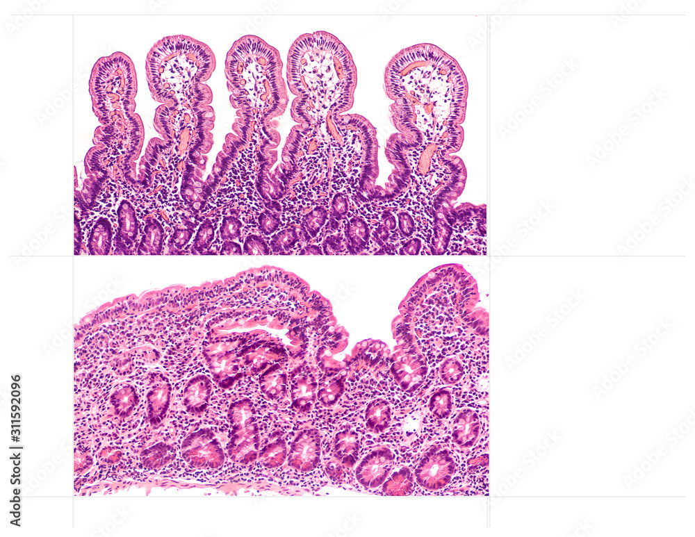 Celiac disease (sprue, gluten sensitive enteropathy) is an autoimmune ...