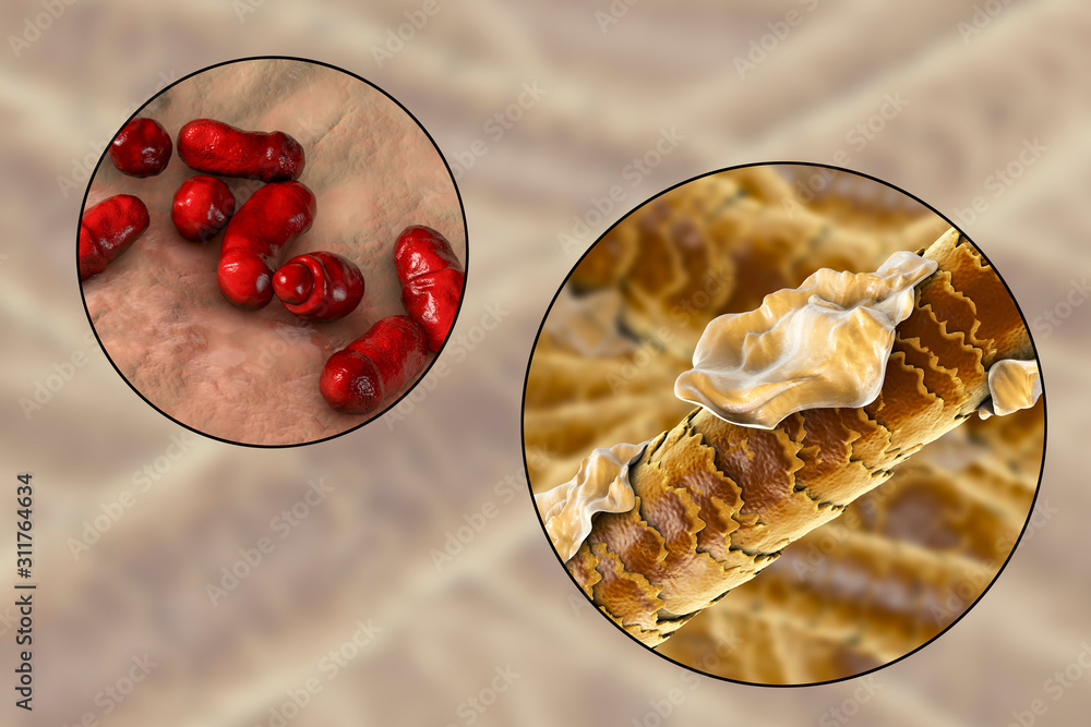 Human hair with dandruff and close-up view of microscopic fungi ...