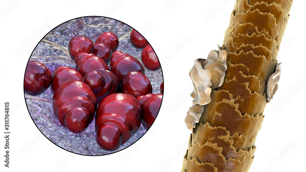 Human hair with dandruff and close-up view of microscopic fungi ...