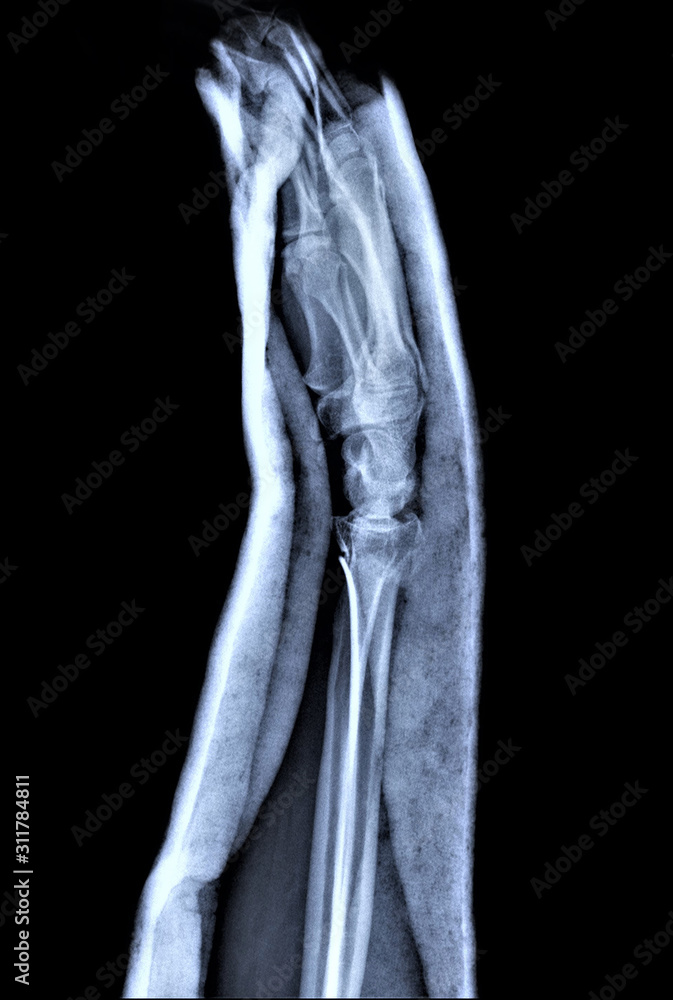 radiography of forearm and wrist bones with a fracture of the distal ...